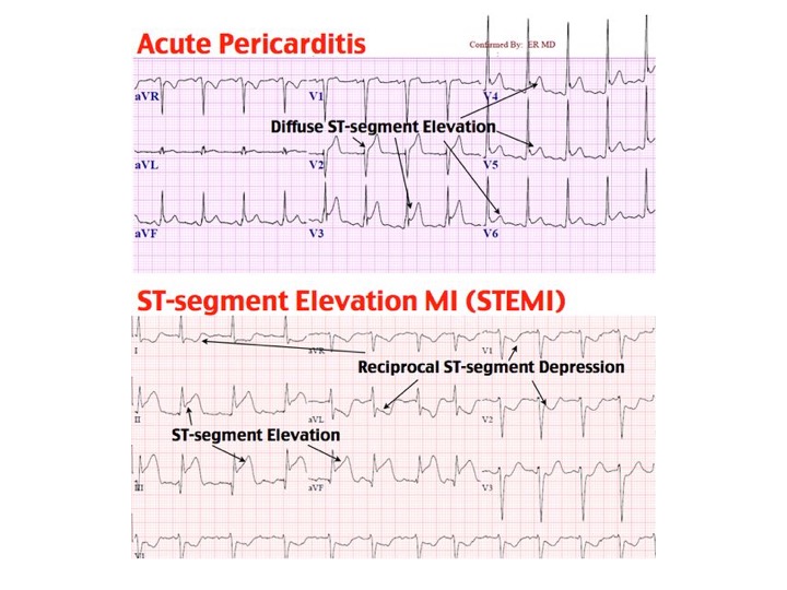 40-STEMI ECG - ED Quality Solutions, LLC