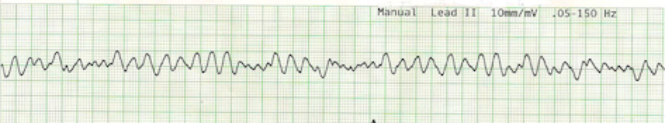 VFib Strip - ED Quality Solutions, LLC